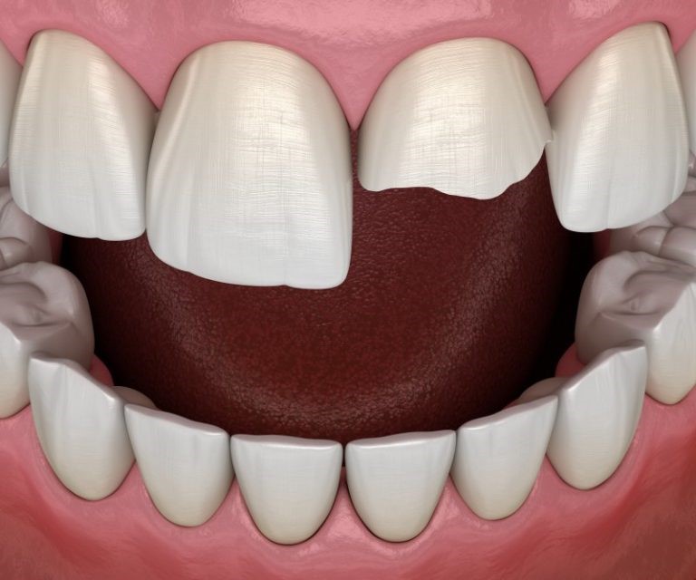 A Chipped Tooth is a Dental Emergency